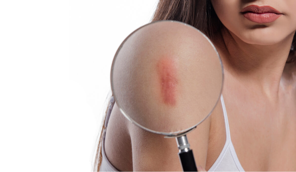 รักษาแผลเป็นคีลอยด์ | Skinserity